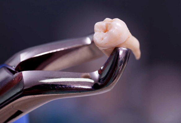 When Is a Tooth Extraction Necessary? | Denville Dental Group | Tooth ...