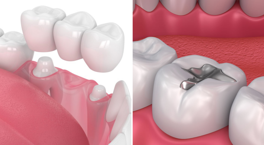 Restoring Your Smile: A Guide to Getting a Broken Dental Crown Repaired ...
