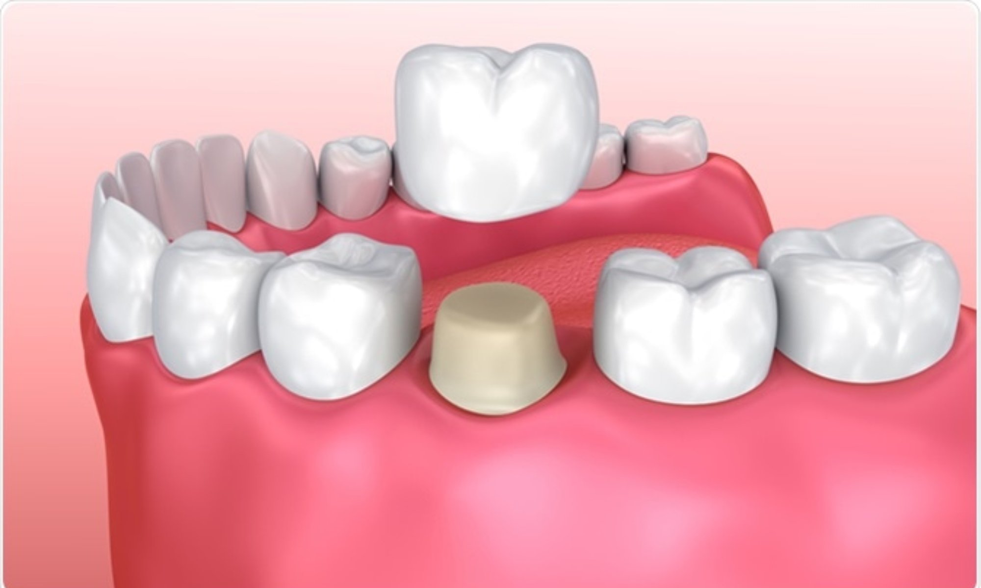 Fillings vs. Crowns - Which One Do You Need?
